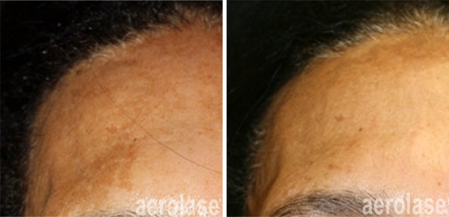 Laser Hair Removal & Skin Resurfacing | Aerolase® - Iconic Medical Arts